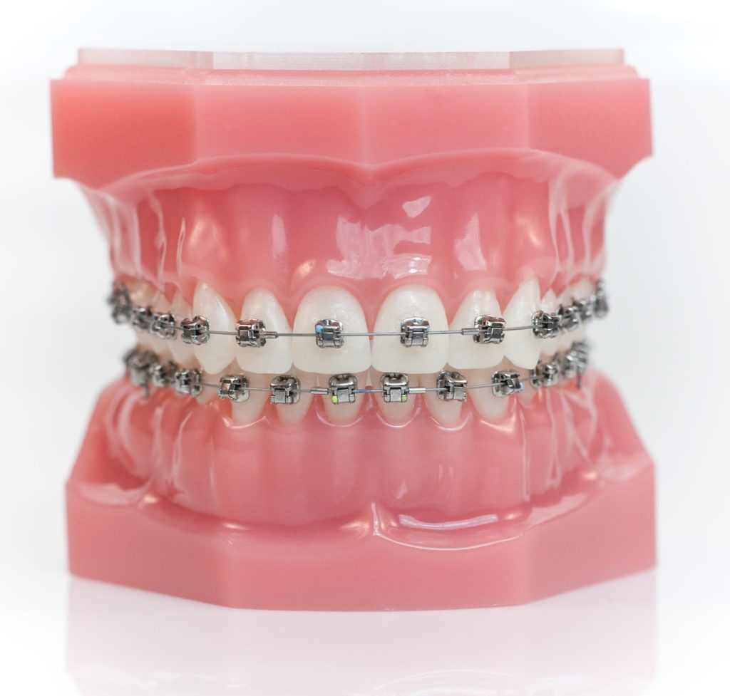 Metal Braces | Braces Mebane | Durham Braces | Smith & Heymann